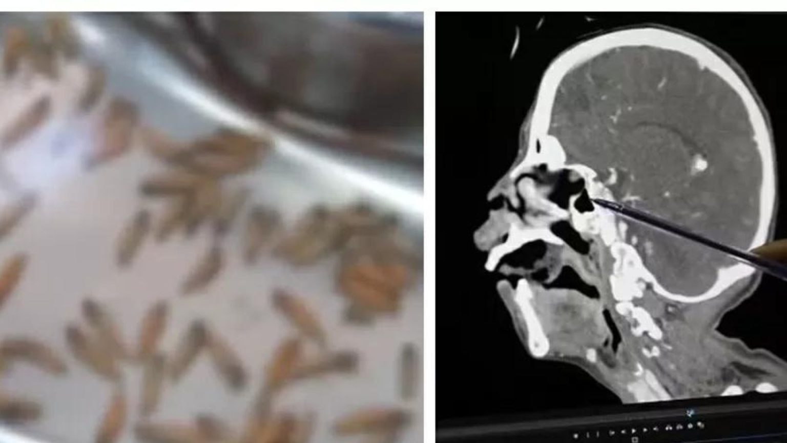 Médicos encontram 150 larvas na boca de uma mulher; saiba mais sobre miíase